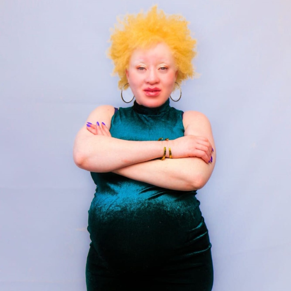Albino actress overcomes abuse, champions rights for albinism